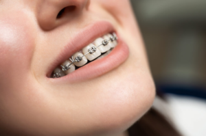 Invisalign vs Braces: Which Is Right for You? | DentUrgent